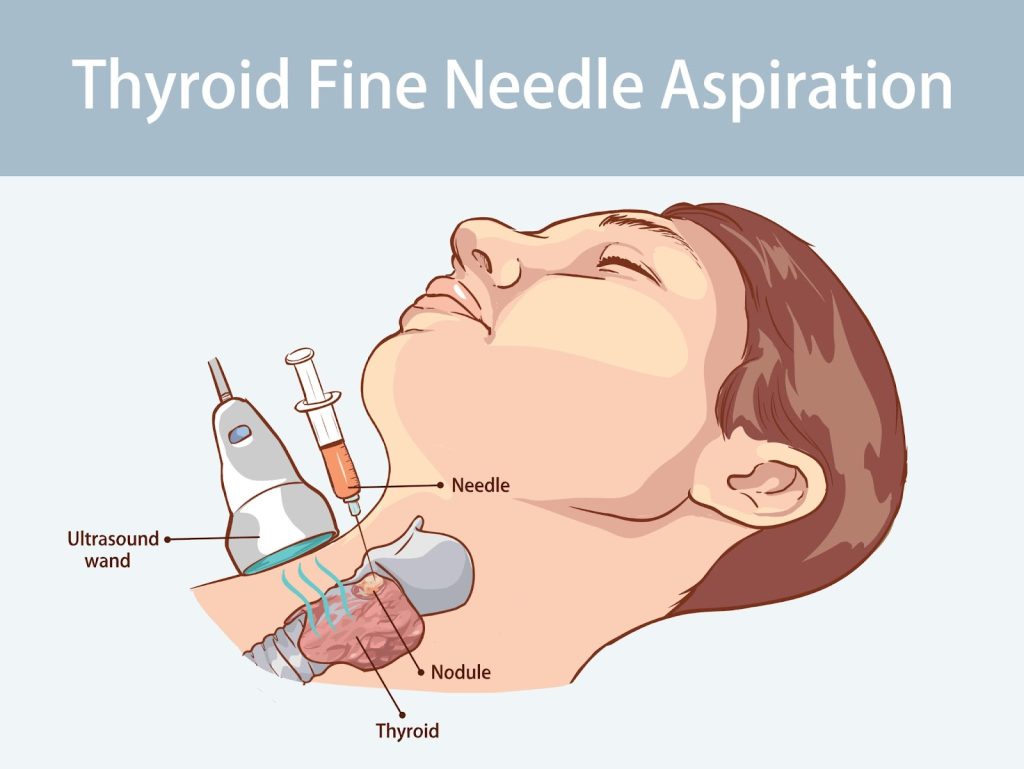 Ultrasound Guided Aspiration & Decom of Thyroid Cysts | ACE Specialist ...