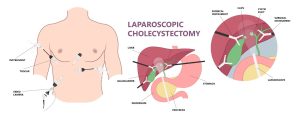 Gallbladder Removal Surgery (Cholecystectomy) | ACE Specialist Clinic