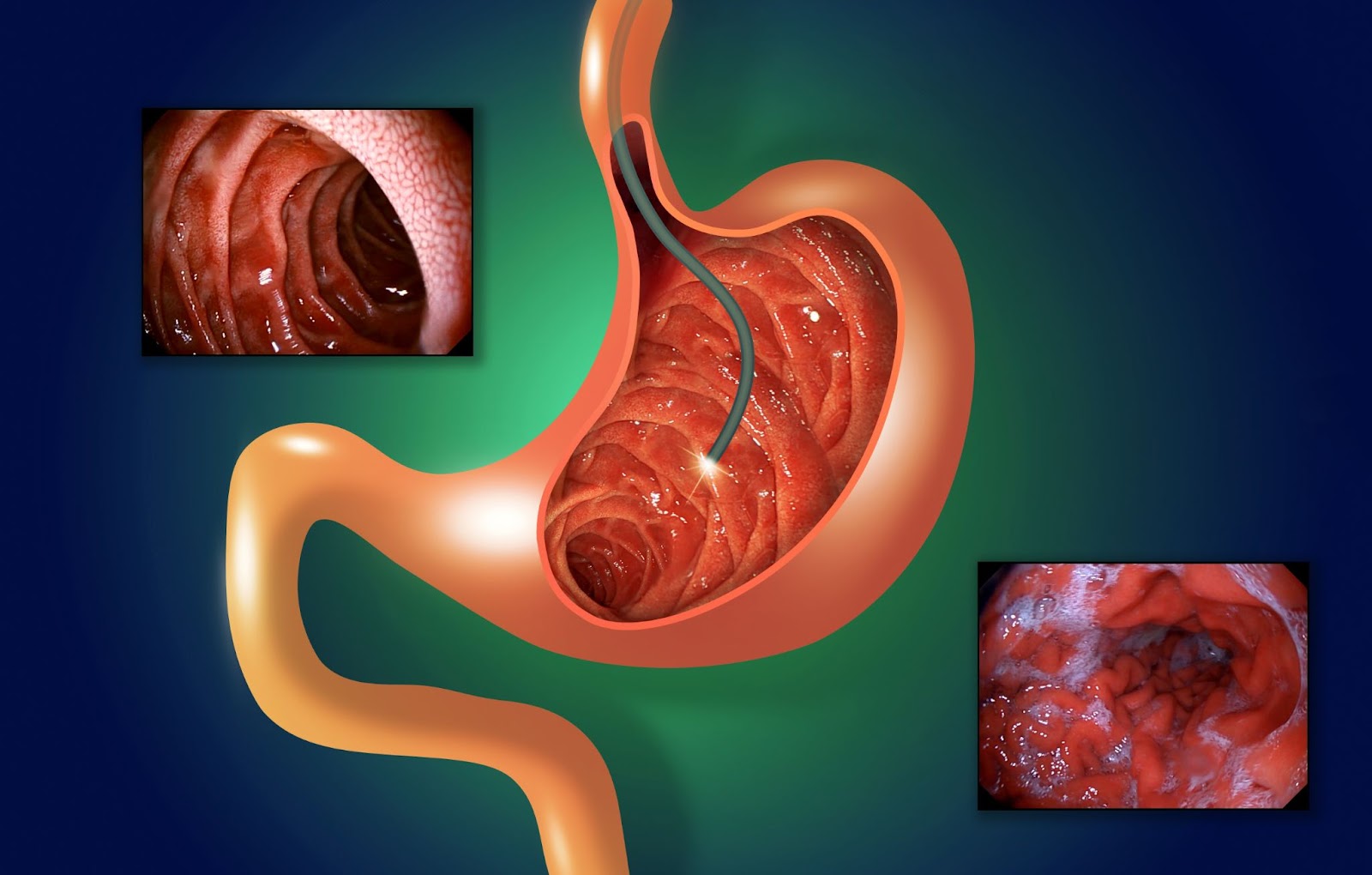 GI Bleeding Causes, Diagnosis & Treatment | ACE Specialist Clinic